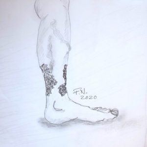 Offenes Bein München Ulcus cruris Offener Fuß Behandlung | Dr. Netzer ...